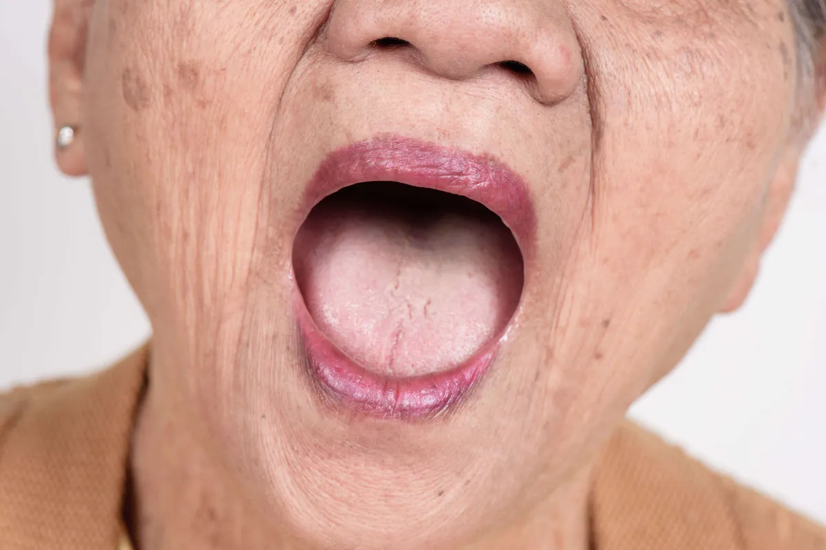 Suolisto-oireisen suuhun kannattaa kurkistaa: Tarjolla arvokkaita ...