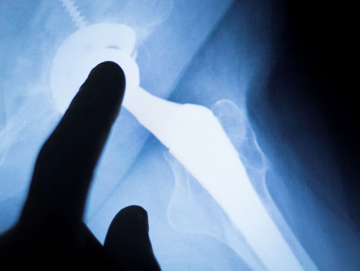 Tekonivelet vaikuttavat synnytystapaan – Raskaus ja synnytys ovat ...