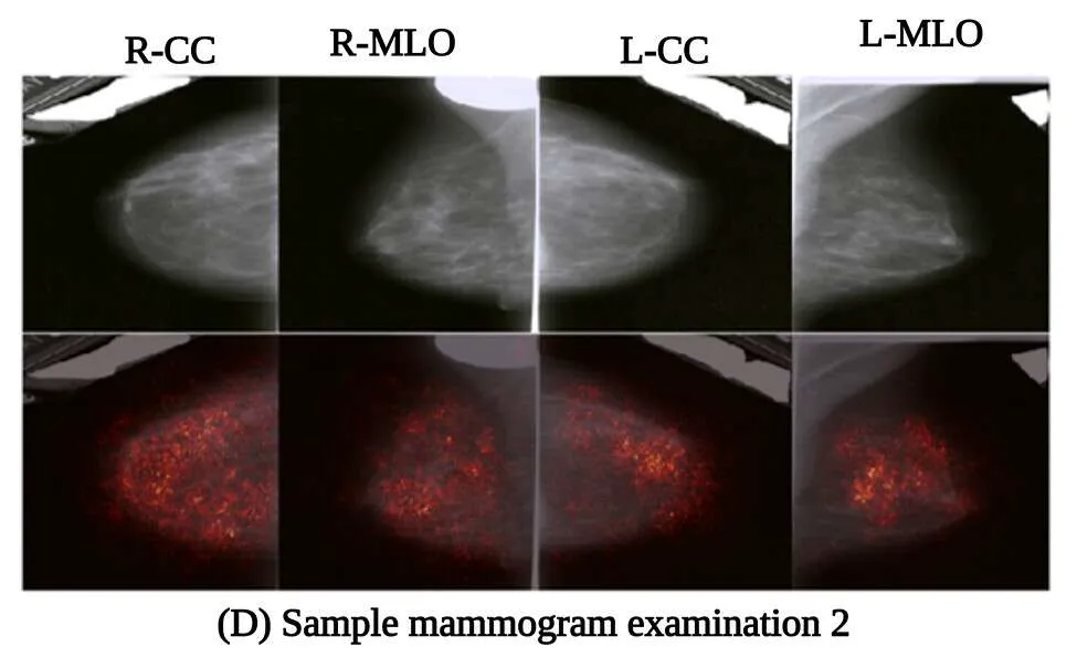 A New Artificial Intelligence Algorithm Aids In Breast Cancer Diagnosis Tivi In English 