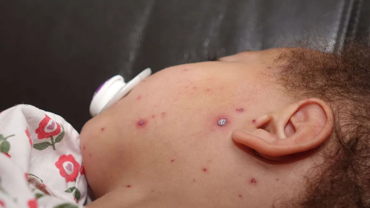 Tuhkarokko on jo hyvin harvinainen sairaus Suomessa | Kauppalehti